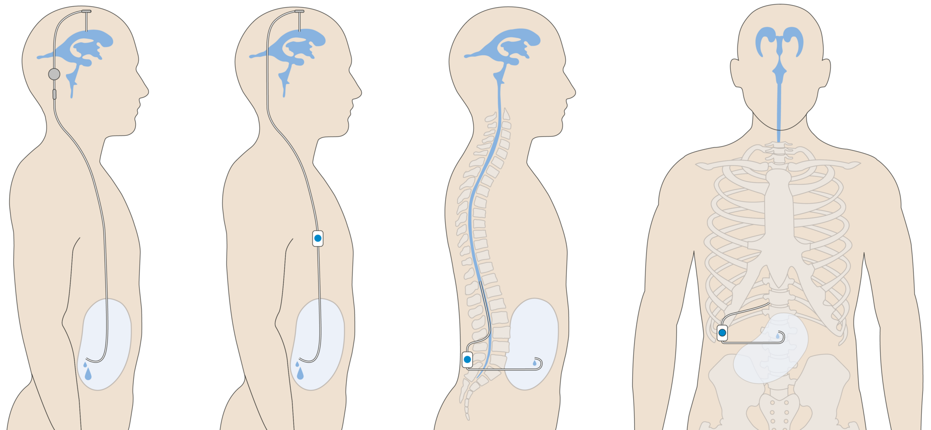 LP-Shunt vs. VP-Shunt | MIETHKE