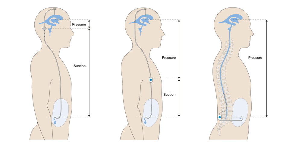 LP-Shunt vs. VP-Shunt | MIETHKE