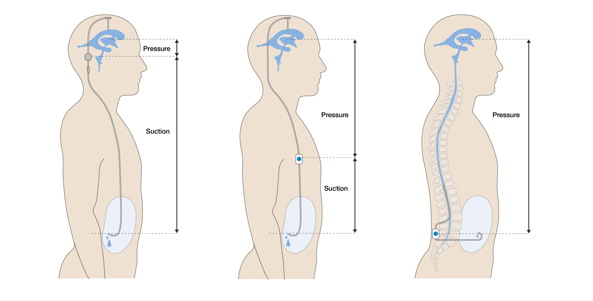 LP-Shunt vs. VP-Shunt | MIETHKE