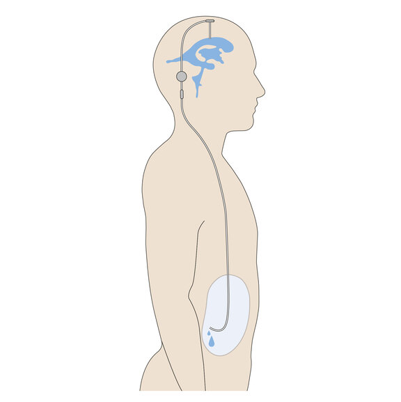 VP Shunt vs LP Shunt in Hydrocephalus Treatment | MIETHKE