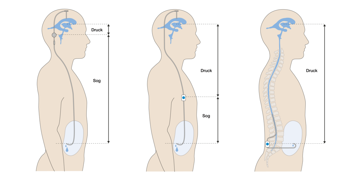 LP-Shunt vs. VP-Shunt | MIETHKE