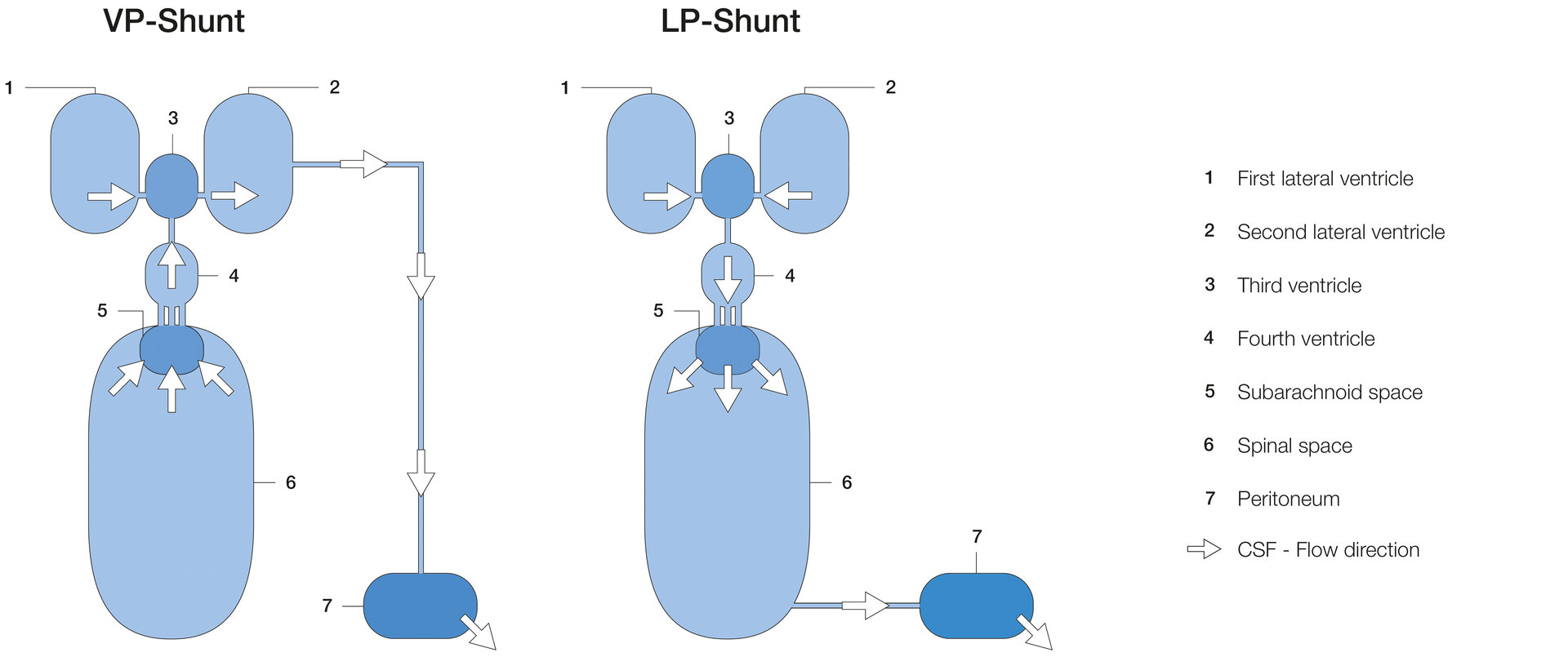 LP-Shunt vs. VP-Shunt | MIETHKE