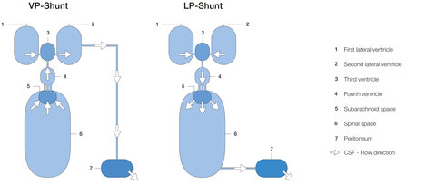 LP-Shunt vs. VP-Shunt | MIETHKE