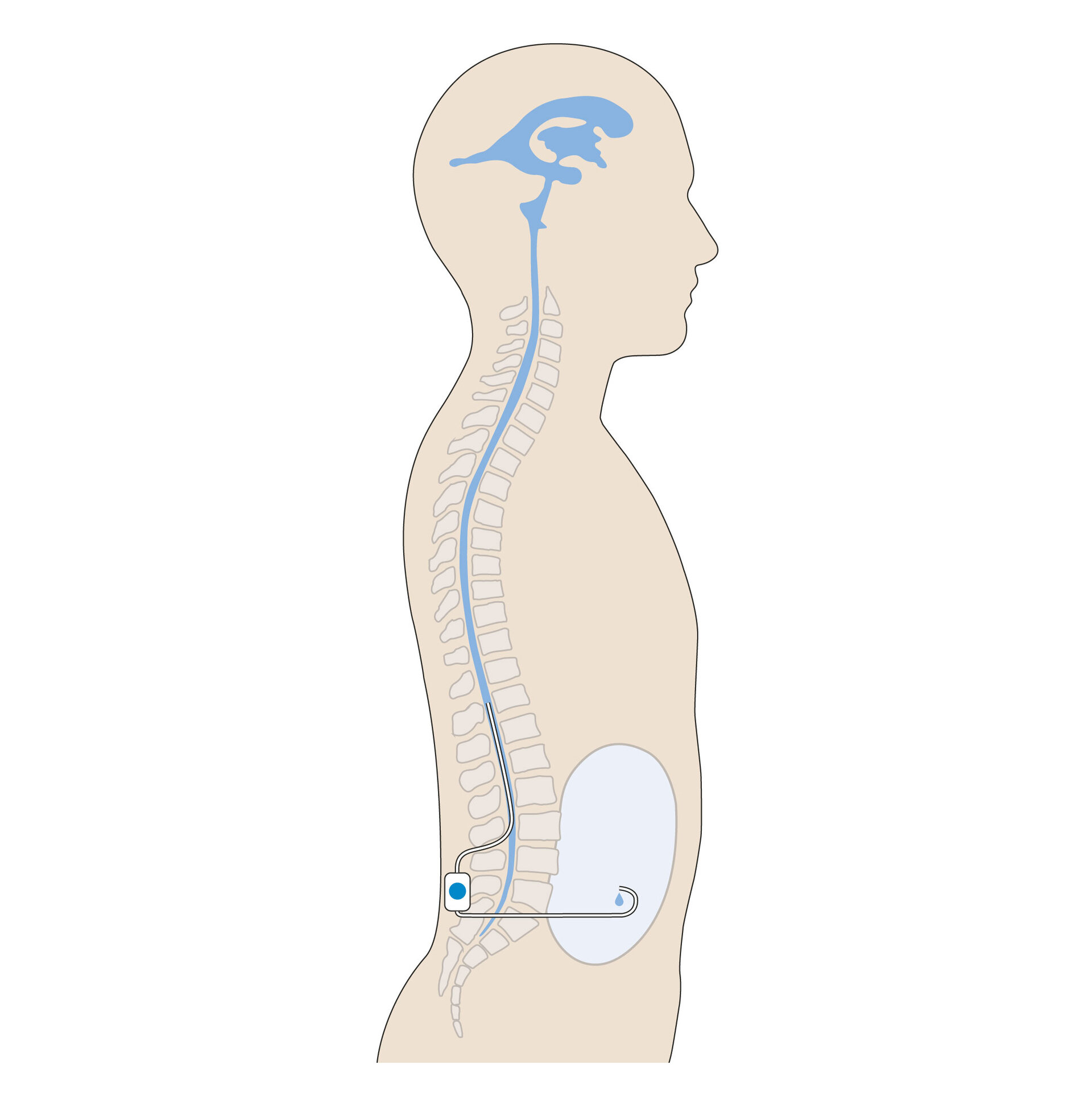 VP Shunt vs LP Shunt in Hydrocephalus Treatment | MIETHKE