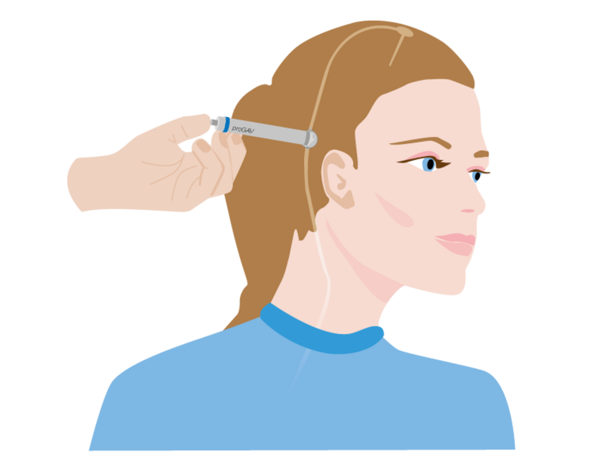 proGAV: Our first adjustable valve | MIETHKE