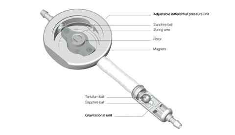proGAV: Our first adjustable valve | MIETHKE