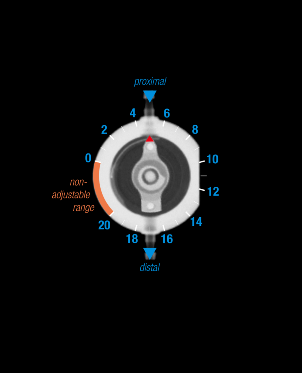 proGAV: Our first adjustable valve | MIETHKE